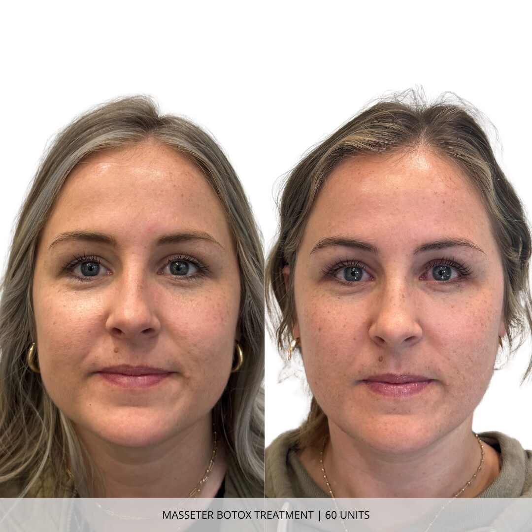 Specialty And Micro Botox | Fargo Wellness District