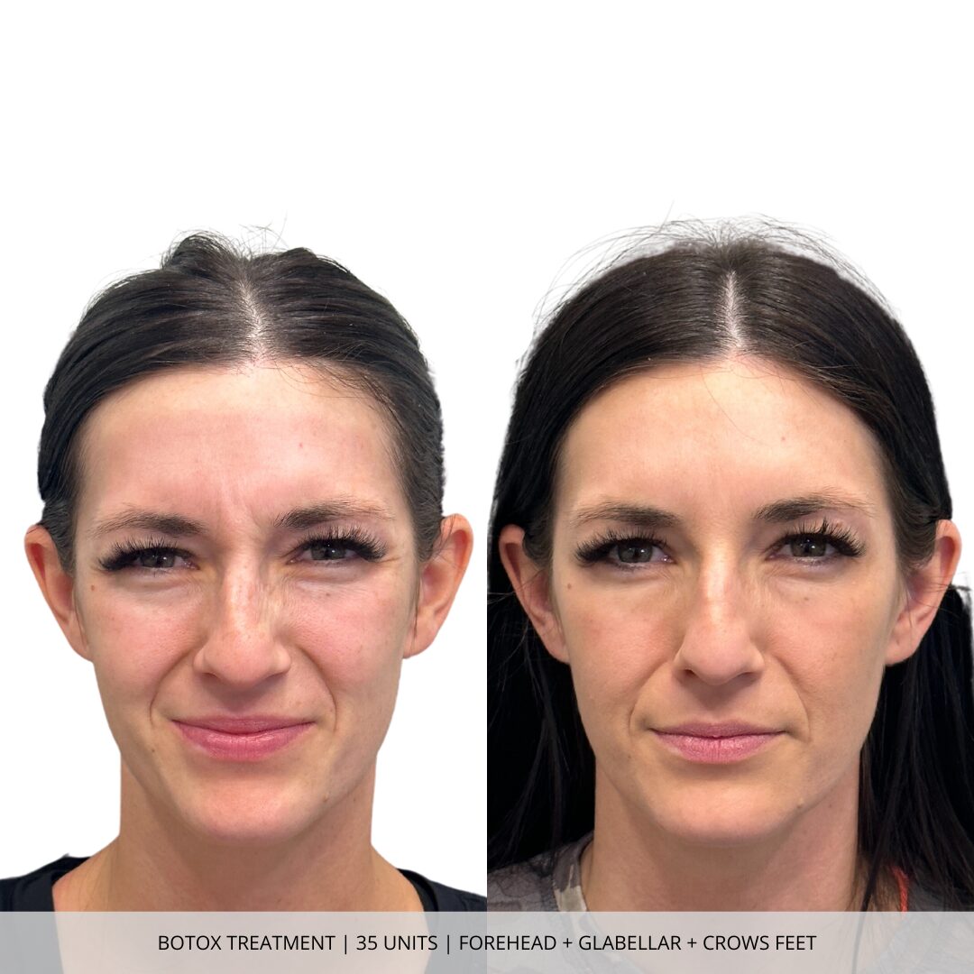 Specialty And Micro Botox | Fargo Wellness District