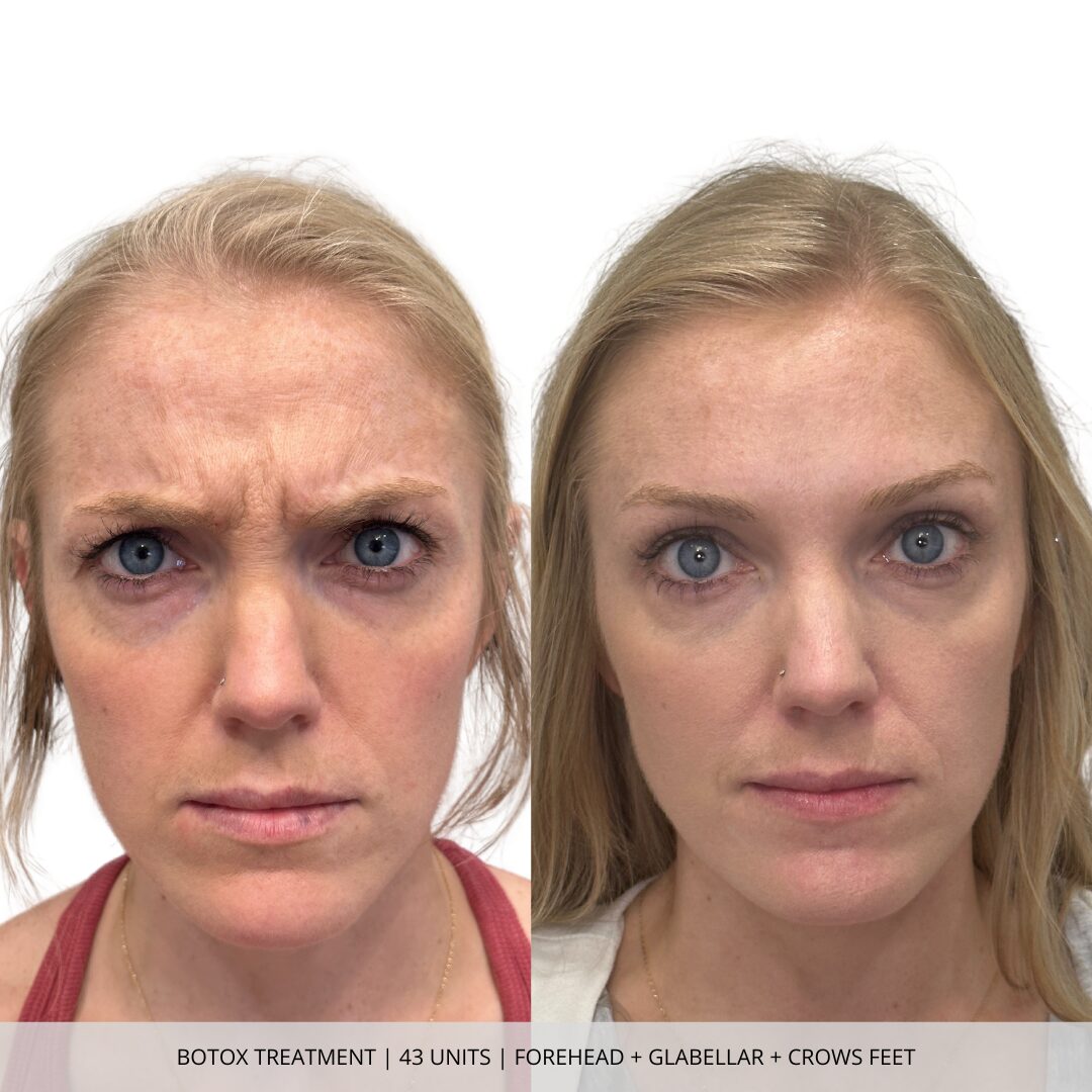 Specialty And Micro Botox | Fargo Wellness District