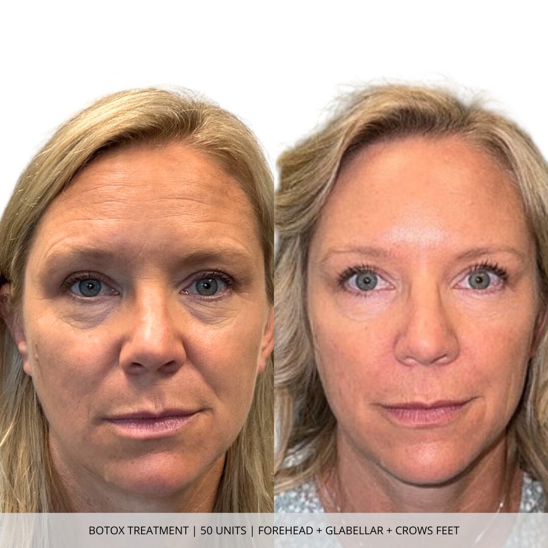 Specialty And Micro Botox | Fargo Wellness District