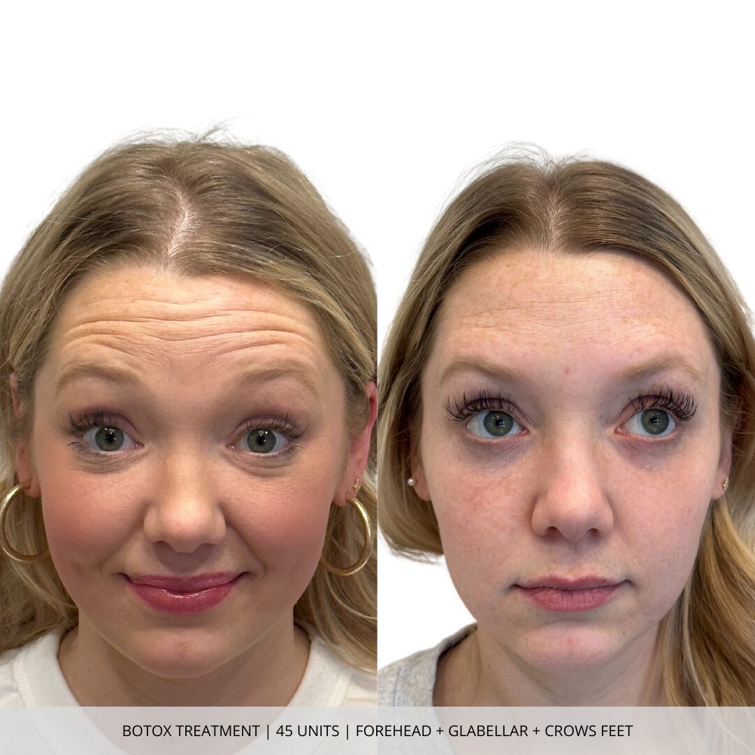 Specialty And Micro Botox | Fargo Wellness District