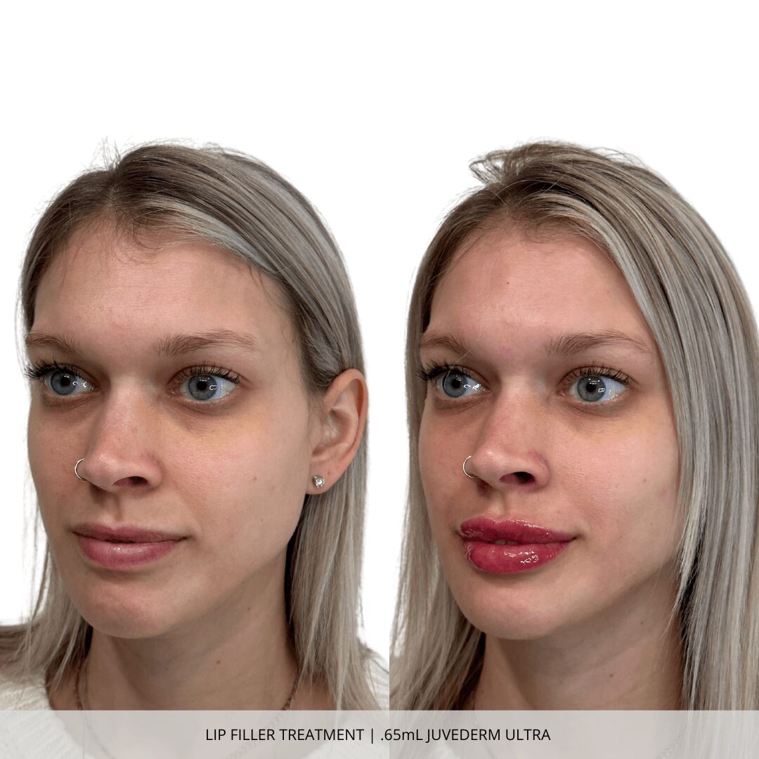 Expert Lip Fillers In Fargo | Master Injectors