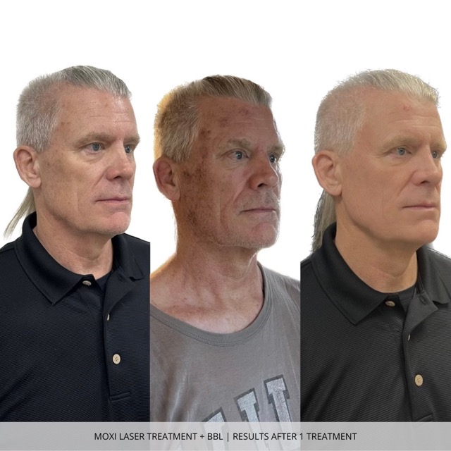 Moxi® Laser Skin Rejuvenation | Fargo Wellness District