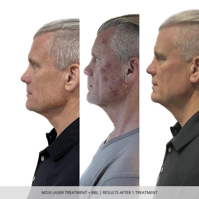 Moxi® Laser Skin Rejuvenation | Fargo Wellness District