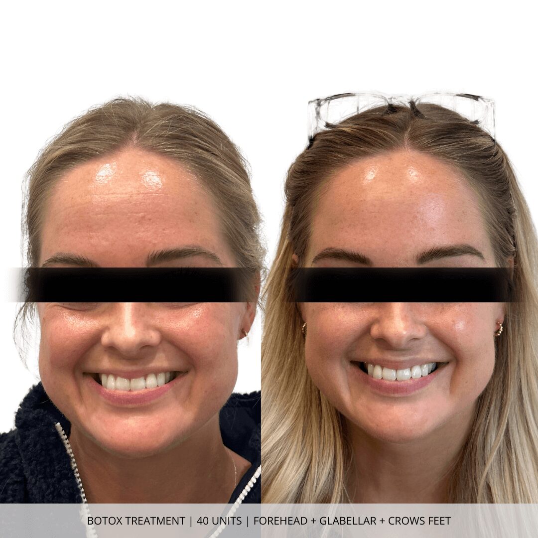 Specialty And Micro Botox | Fargo Wellness District