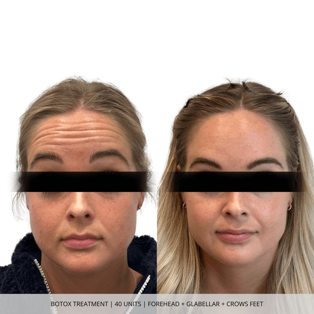 Specialty And Micro Botox | Fargo Wellness District